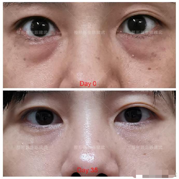 How to improve the tear ditch hidden in the face?The doctor shared 3 ...