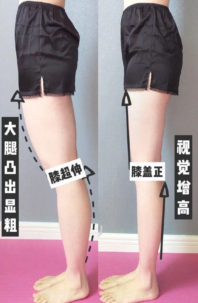 "Straighten the beautiful legs" get rid of pelvic forward tilt and knee ...