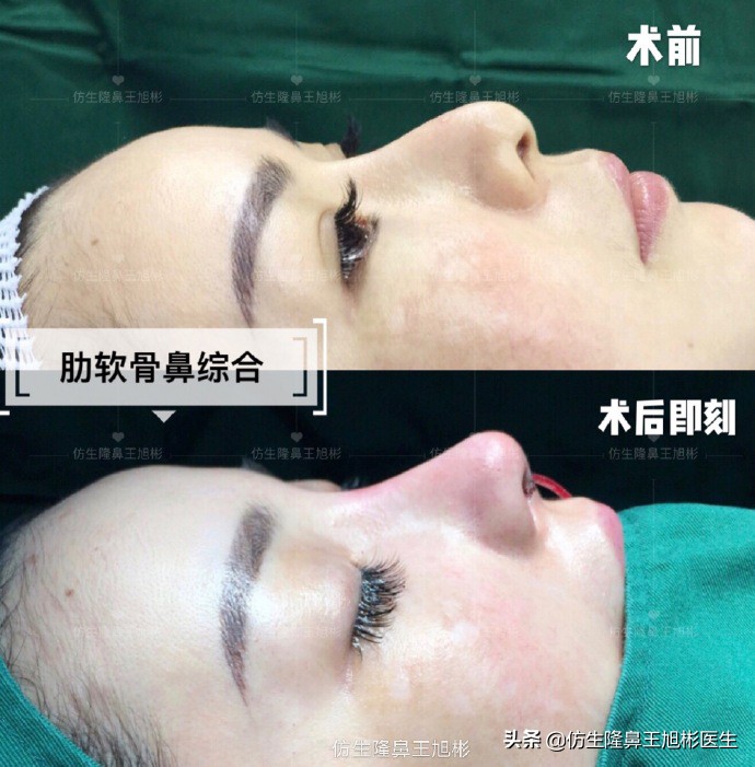 "Hook nose" is fierce and old, how to correct it? - iNEWS