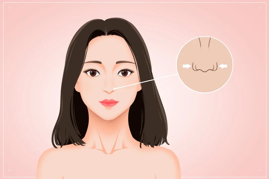 Three solutions for a wide nose - iNEWS