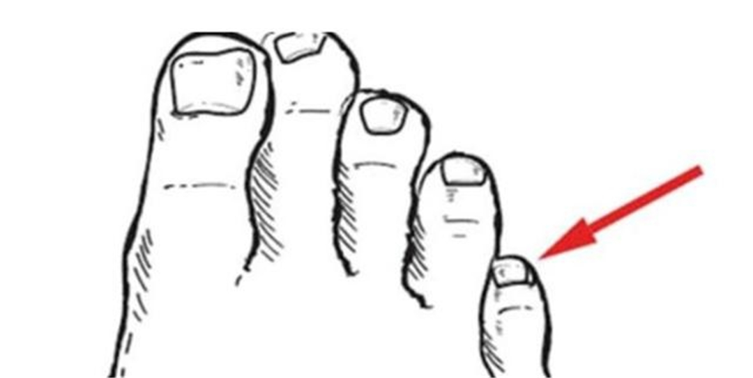 The nail of the little toe grows into two petals, is it really a sign ...