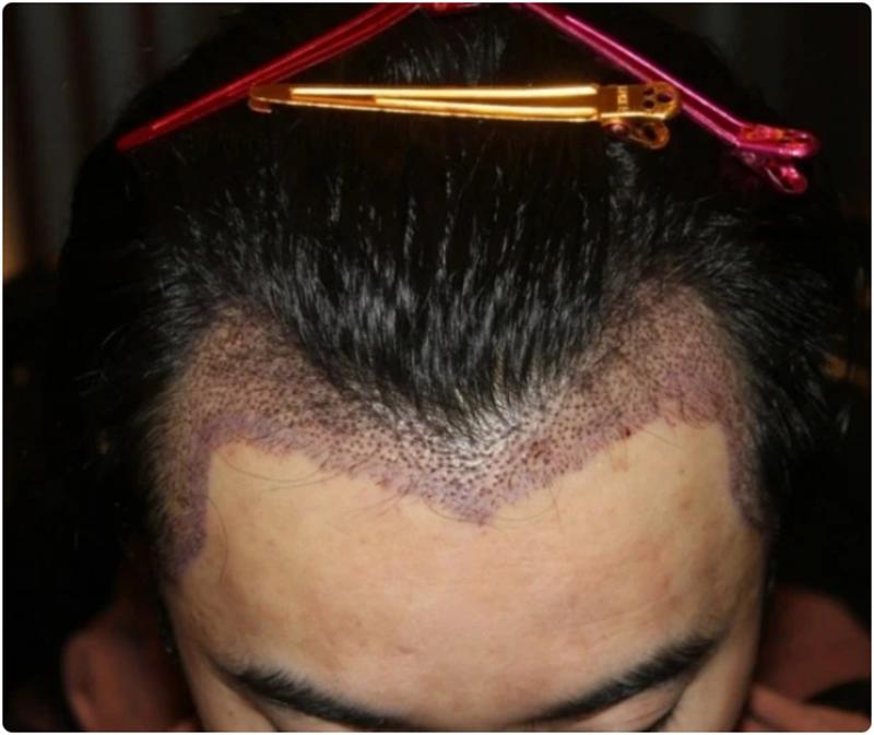 Music talent Hua Chenyu: She has a face full of acne marks and her ...