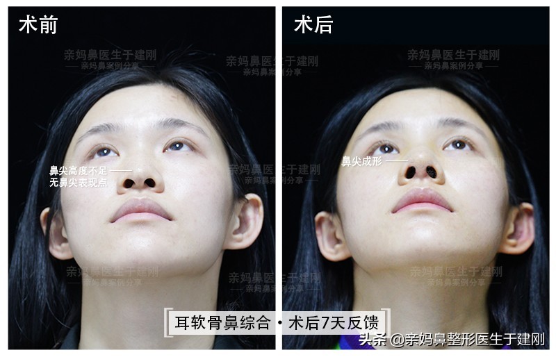 A 22-year-old Hunan girl with a blunt nose and a drooping nose. How ...