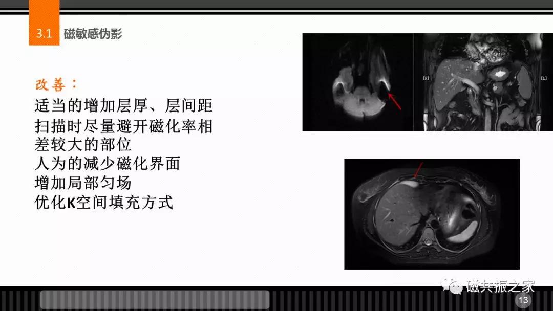 Common MRI artifacts and strategies - iNEWS