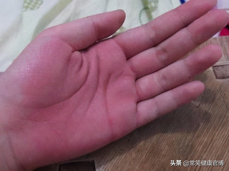 Spread out your palm and look at its color. Discoloration may be a ...