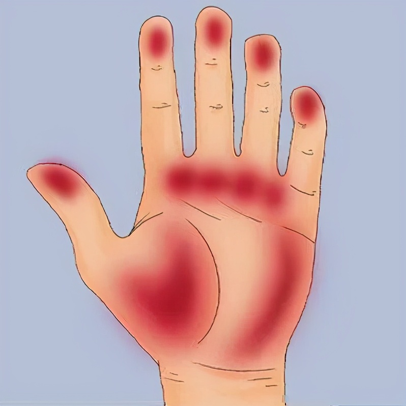 The "palm" of the liver distress signal, what is the liver palm?What ...