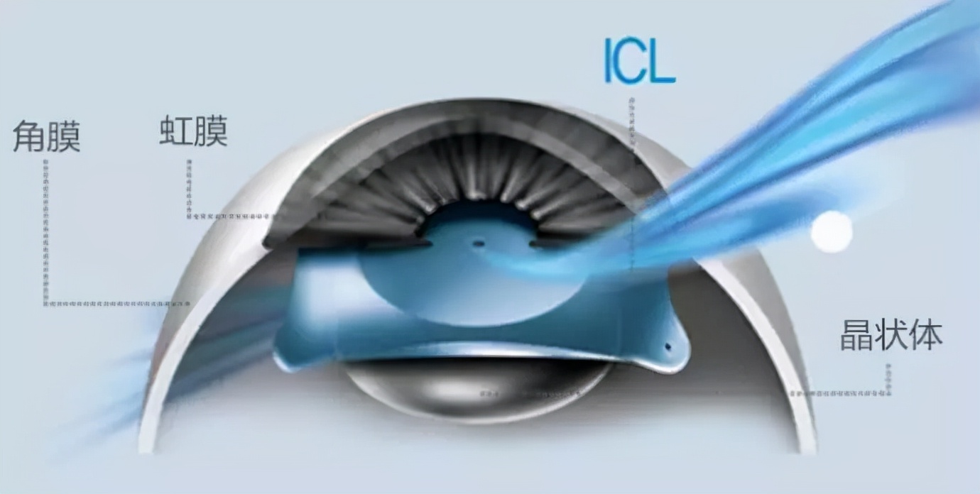 How to choose myopia surgery?You will understand everything after ...