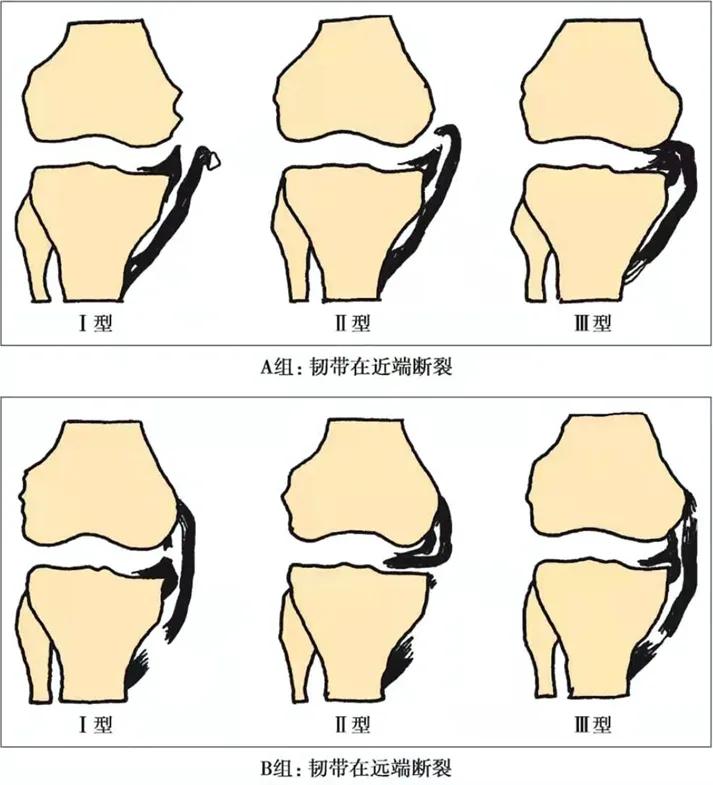 Classification of knee ligament injury and instability - iNEWS