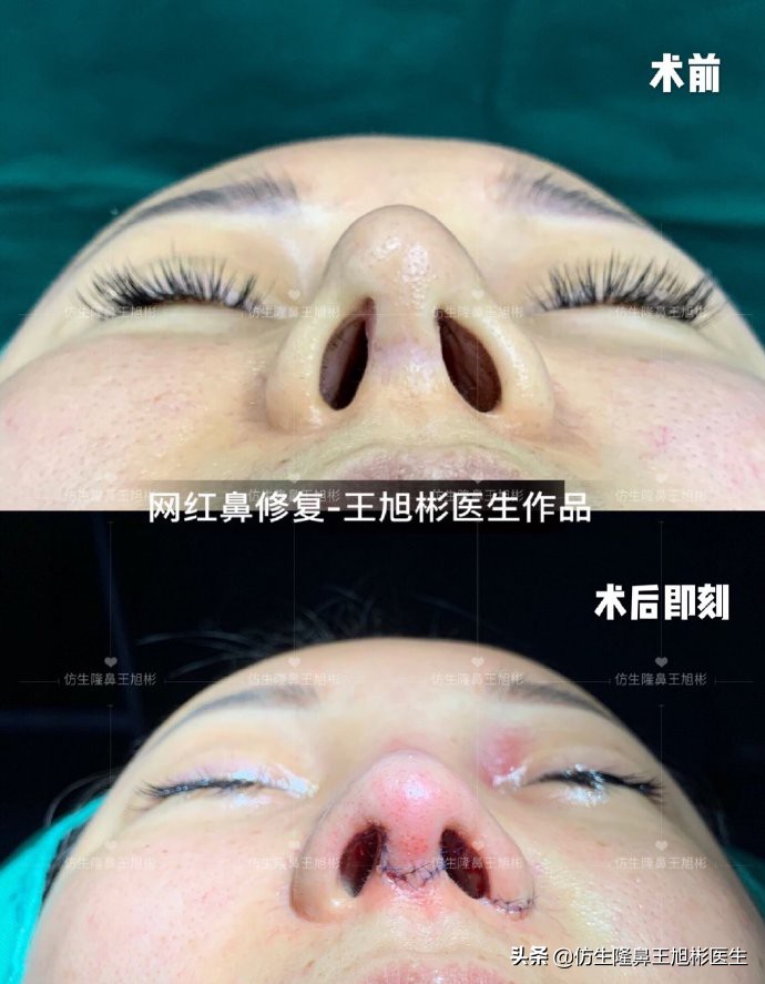 Popular Science: The role of nasal septum extension graft in nasal tip ...