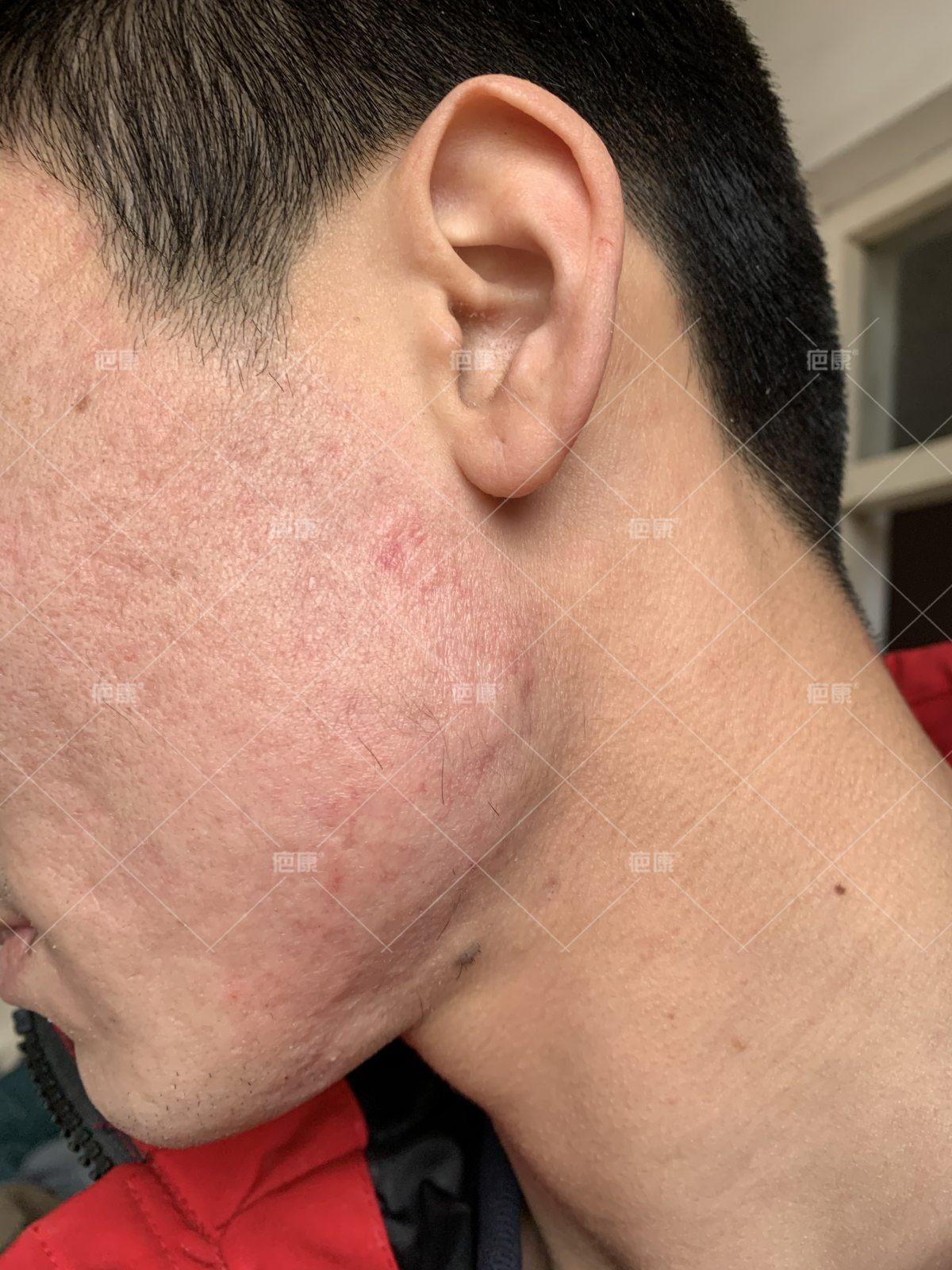 (Scar Kang) If your acne doesn't go down for a long time - iNEWS