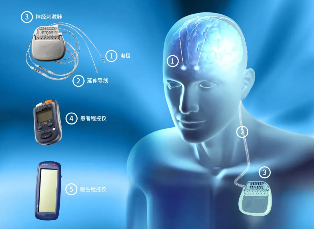 帕金森病DBS手术重要的一环——术前评估-春雨医生