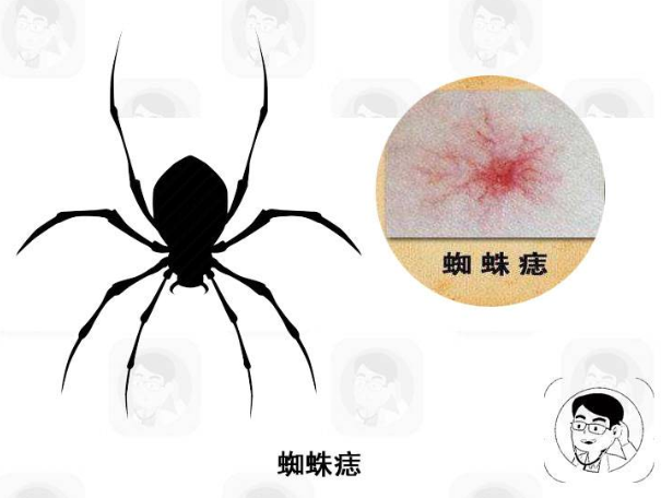 The sudden appearance of a spider web-like mole on the body may be a ...