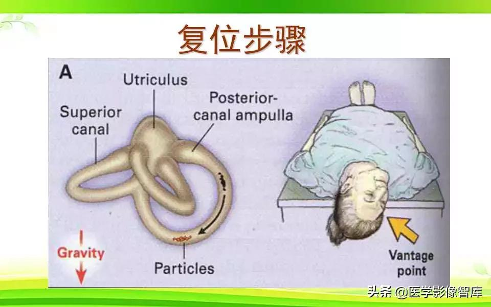How to differentiate and diagnose "central positional vertigo" that is ...