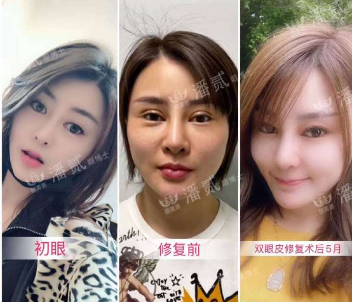 After cutting the double eyelids, the eyebrows are too close to the ...