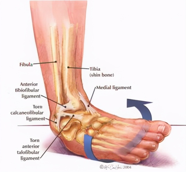 Rice Treatment Principles After Ankle Sprain Inews