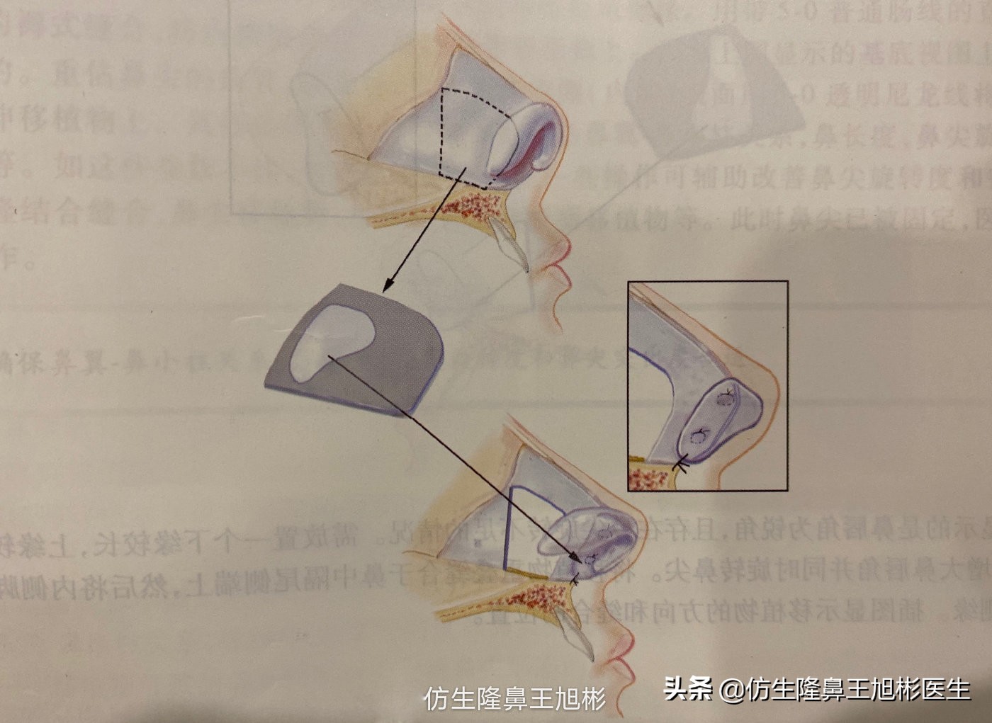 Popular Science: The role of nasal septum extension graft in nasal tip ...