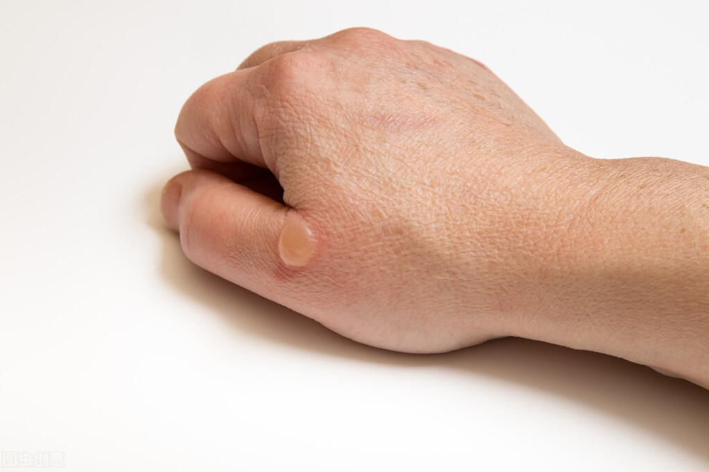 Improper use of warm baby can cause low temperature burns - iNEWS