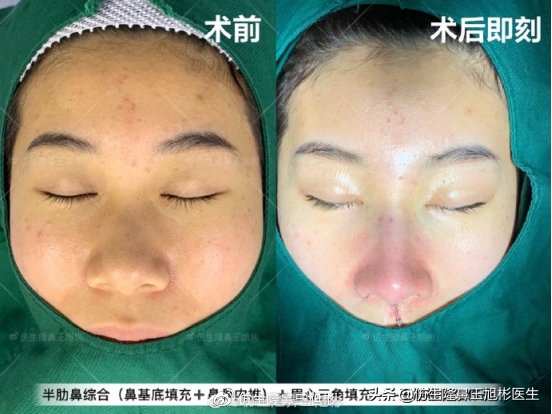 What is a box nose?Can a rhinoplasty doctor make a natural and advanced ...