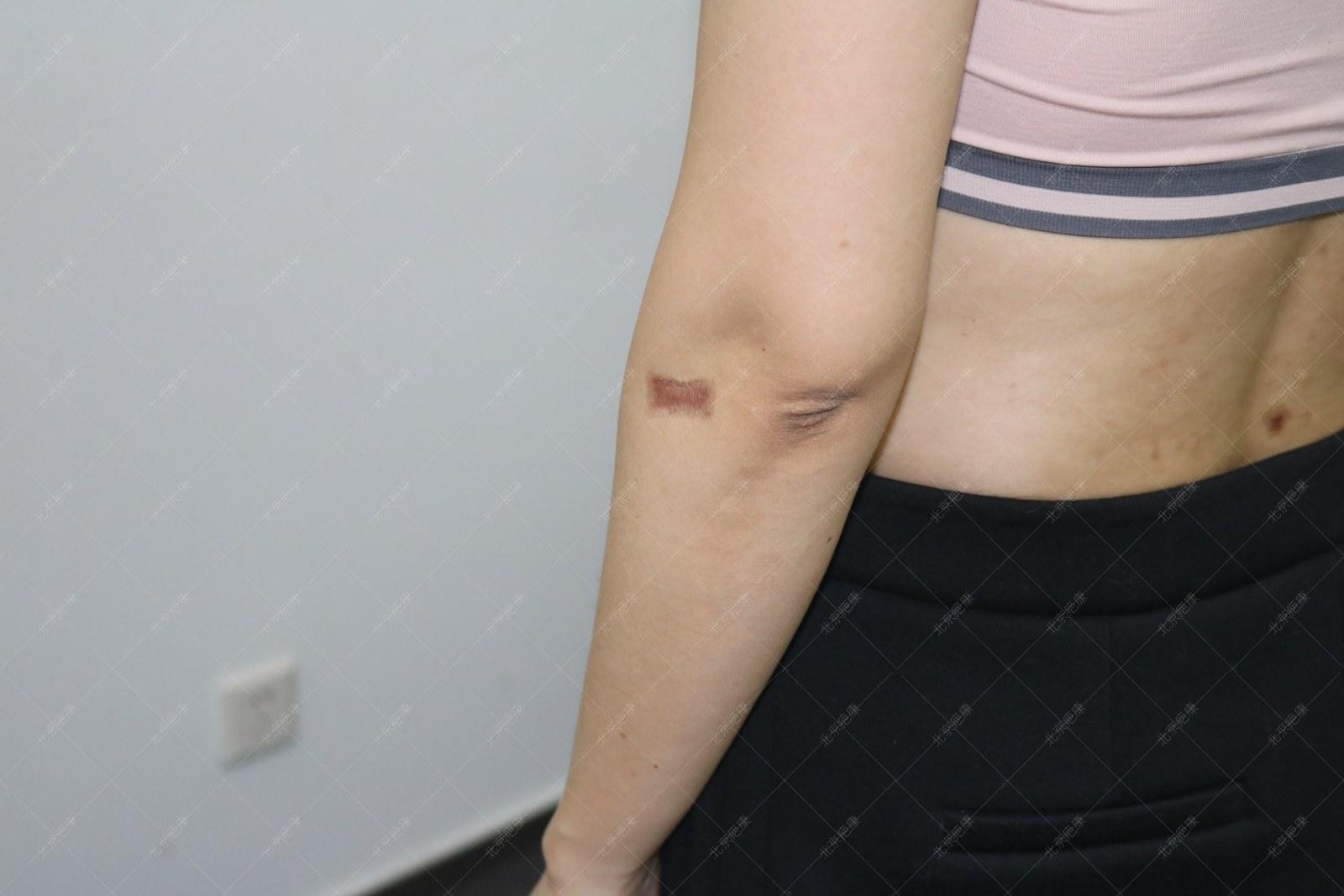 (Scar Kang) I broke my elbow, and my scar grew. - iMedia