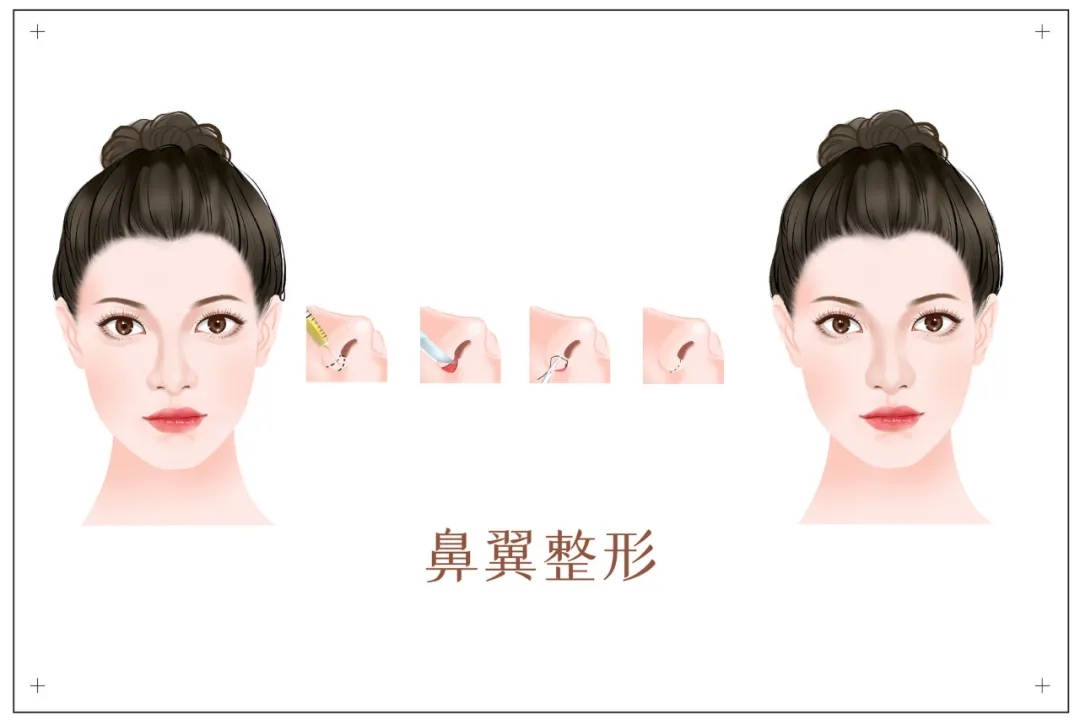 Three solutions for a wide nose - iNEWS