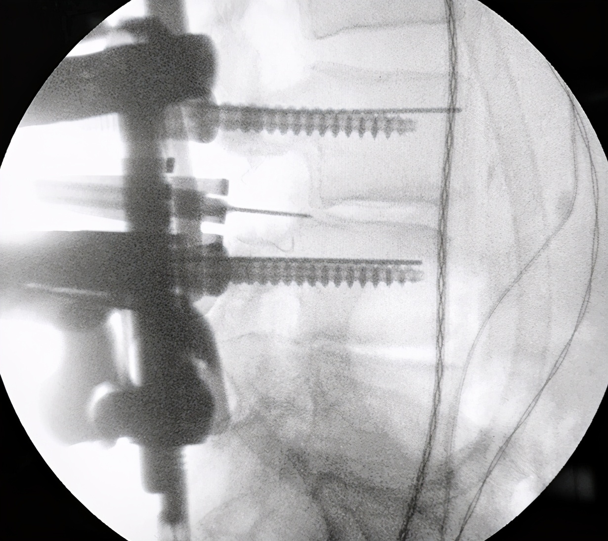 Step By Step：MIS-TLIF微創經椎間孔腰椎融合術 - 資訊咖