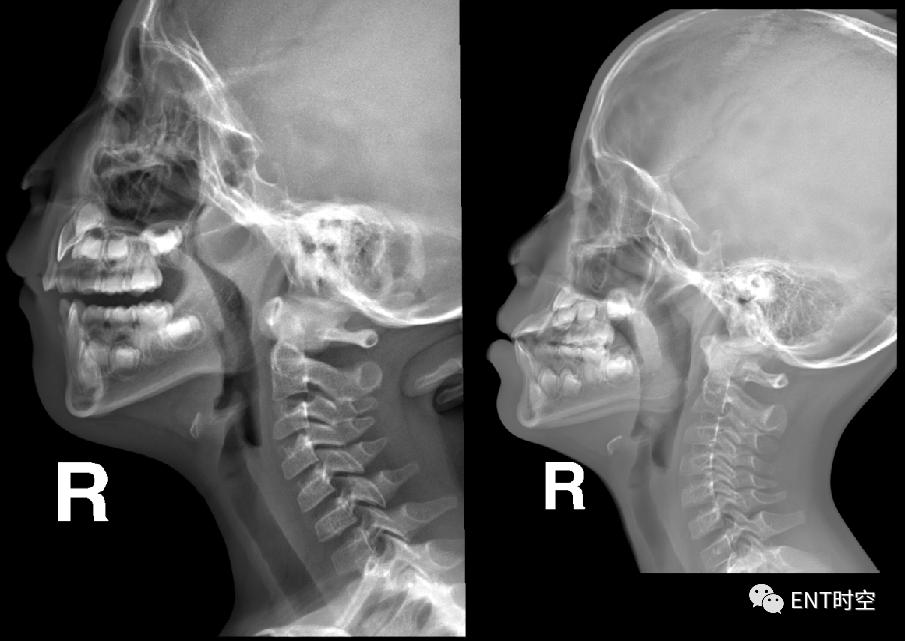 4 methods to measure "adenoid hypertrophy" by X-ray - iMedia