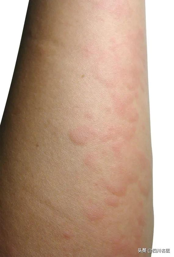 Why do you get hives?Here comes the truth... - iMedia