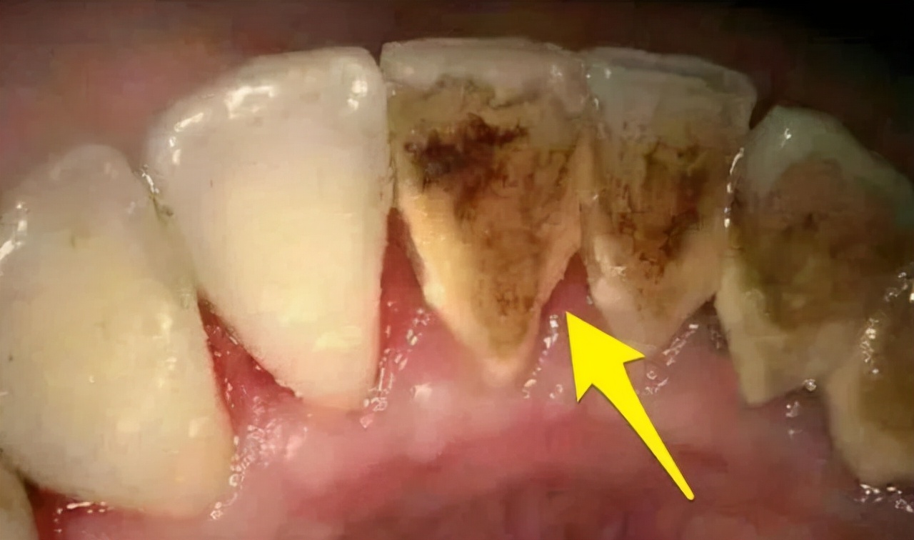 Can "dental calculus" be digged out by myself?Teach you a few tricks ...