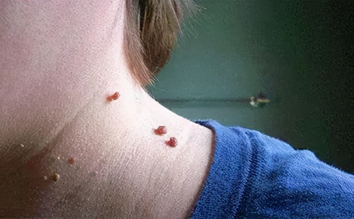 What could be the small meat bumps on the skin?Need treatment?Speak ...