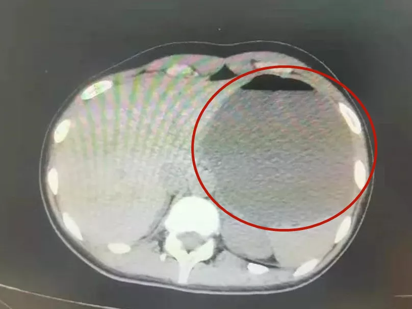 The stomach "explodes" after eating?The 17-year-old guy shouted "Help ...