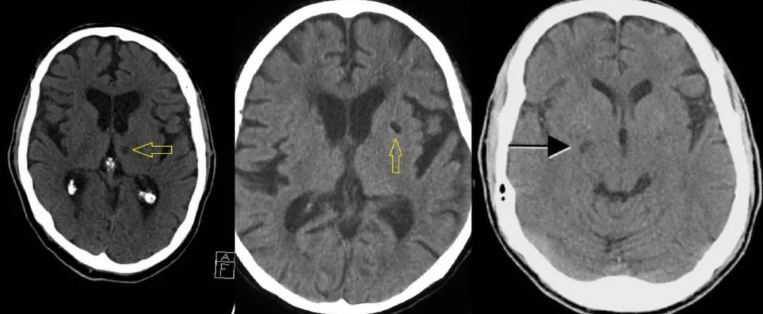 Is lacunar infarction a stroke? - iNEWS