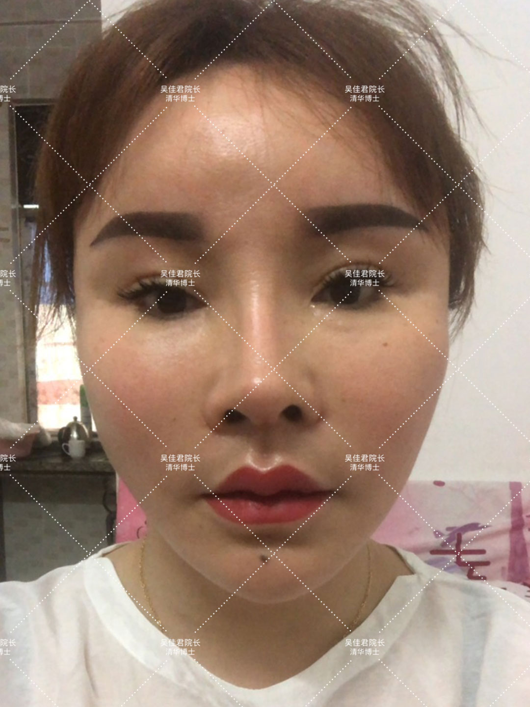 At the age of 50, she had a small facelift, and she changed from an ...