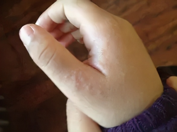 What could be the small meat bumps on the skin?Need treatment?Speak ...