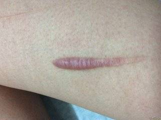Why does the hyperplastic scar recur after treatment? - iNEWS