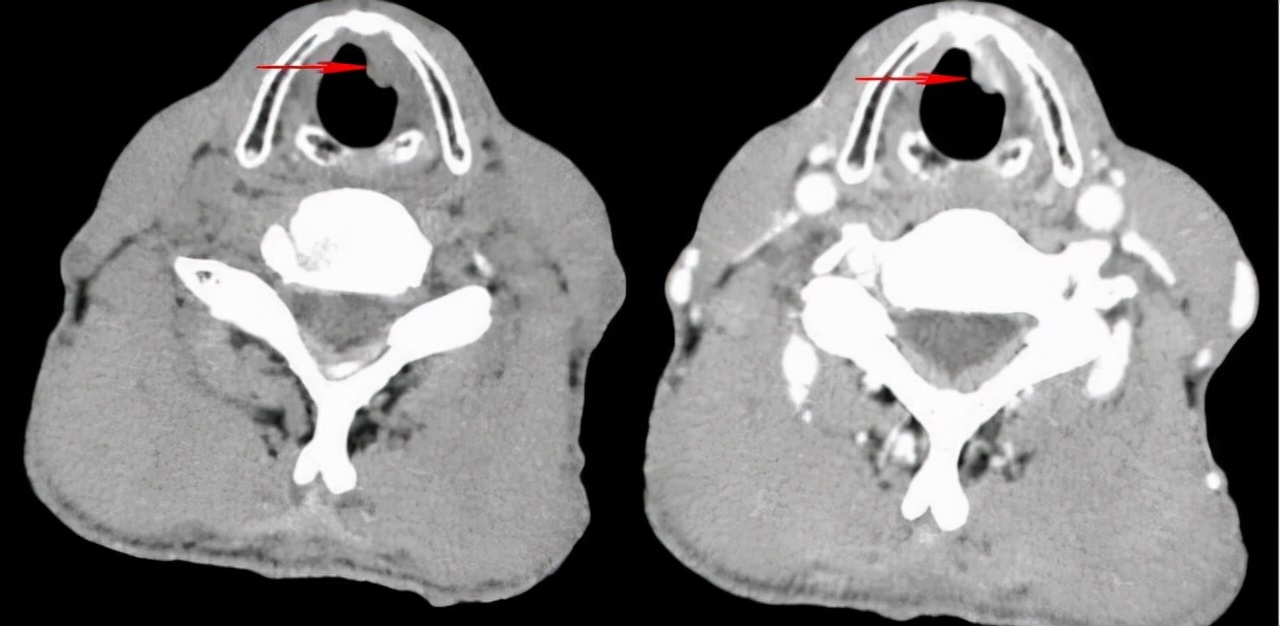 How to treat laryngeal edema? - iNEWS