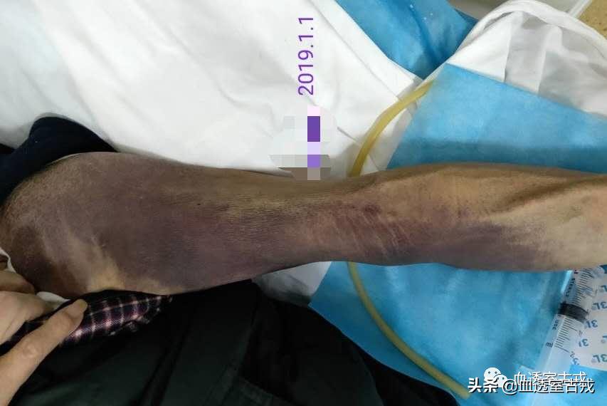 What is the cause of internal fistula puncture hematoma and bruise?How ...