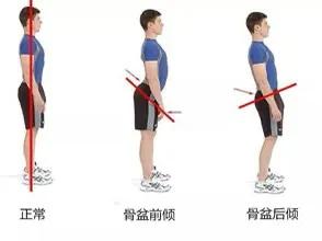 This issue is about whether the pelvis is tilted forward or backward ...
