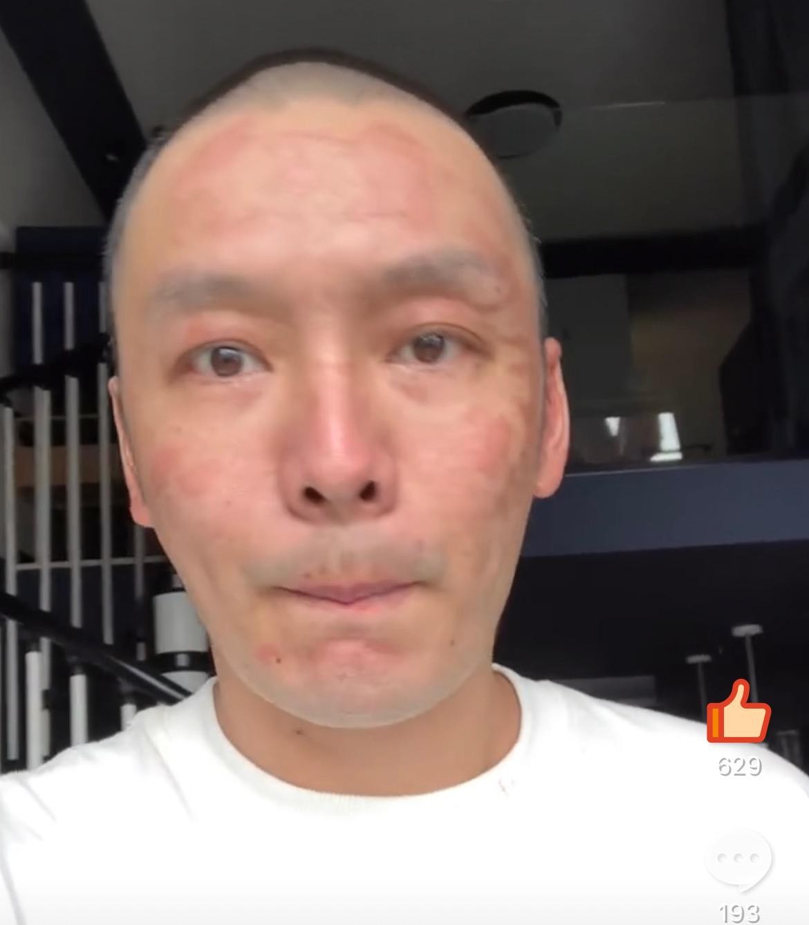 Xu Zhenzhen has been discharged from the hospital with a deep burn ...