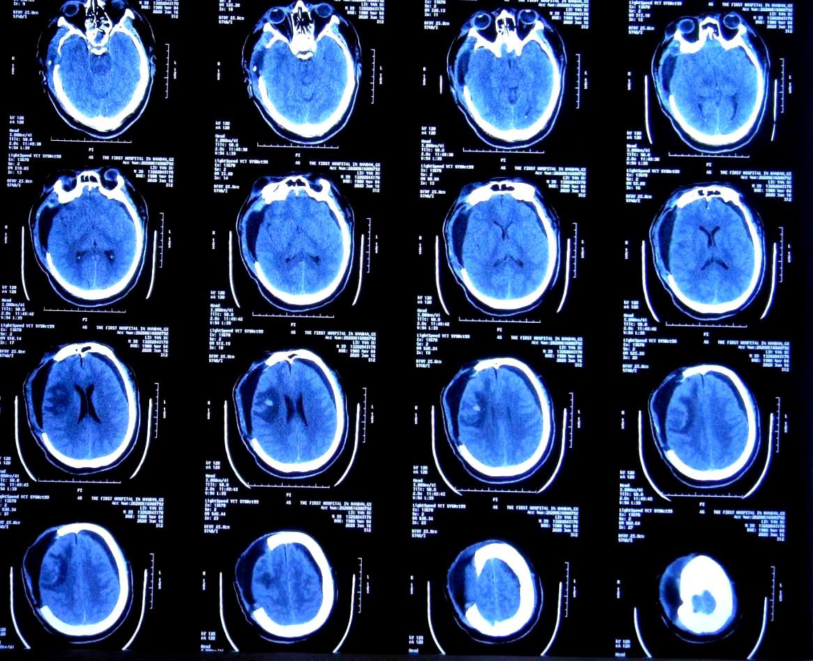 Subdural effusion and encephalocele after traumatic brain injury, two ...