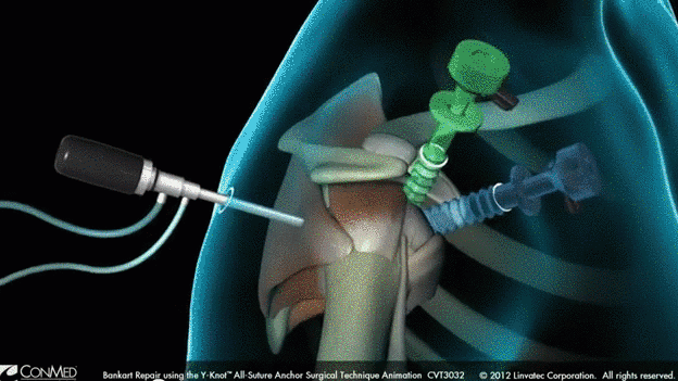 Why is my shoulder often dislocated? - iNEWS