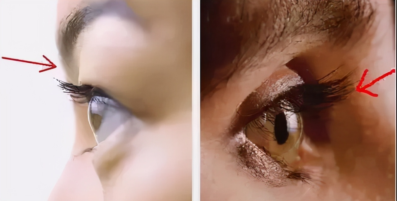 Why are the natural eyes gone?Interpretation of the disappearing double ...