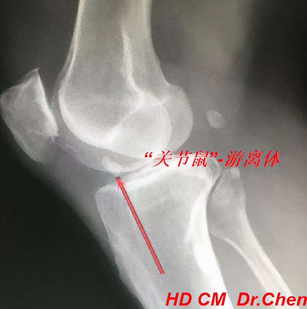 When these symptoms occur, be careful of "joint mice"!Protect your knee ...