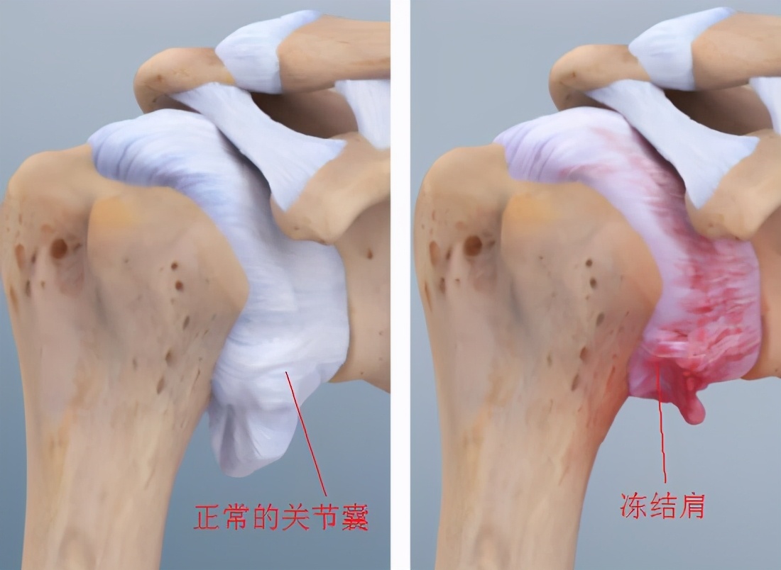 Several stages of frozen shoulder - iMedia