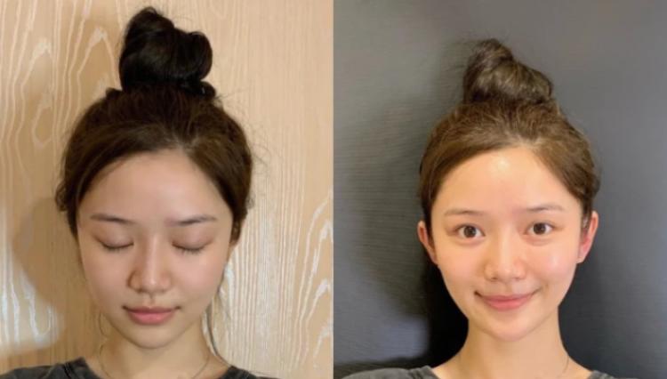 "Elf Ears" became popular in plastic surgery circle!Netizen: My windy ...