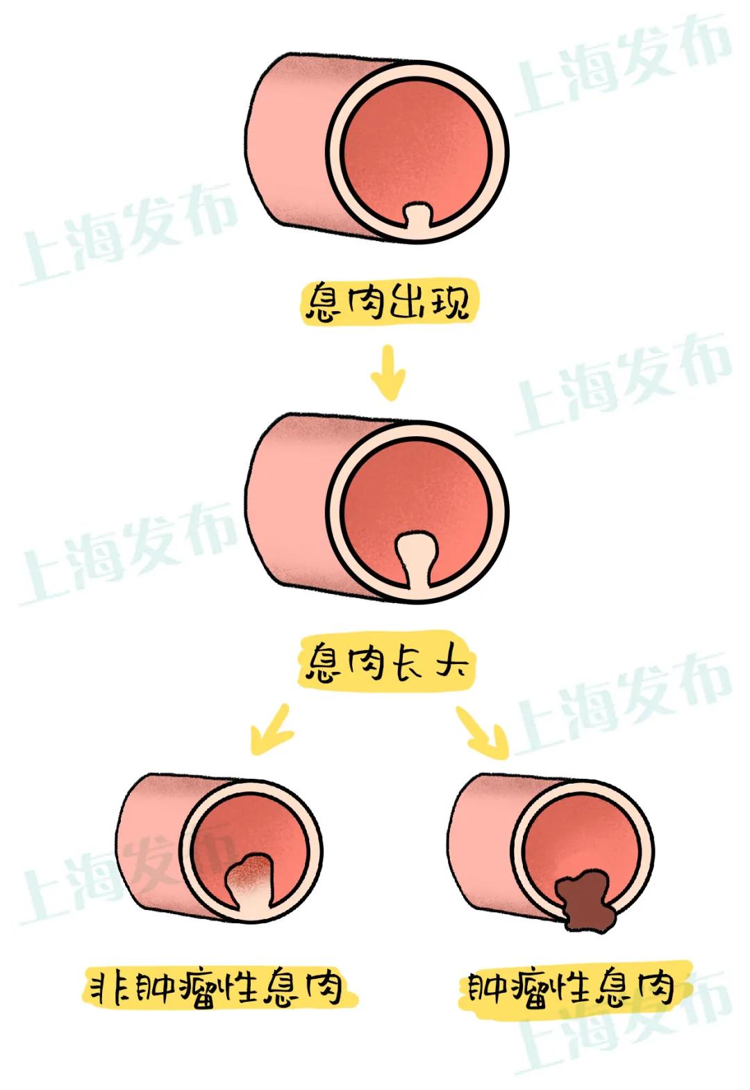 How do intestinal polyps grow?Do you want to cut? - iNEWS