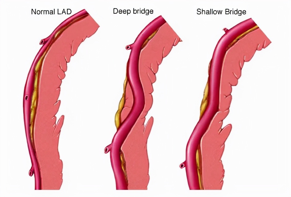What is the myocardial bridge? - iNEWS