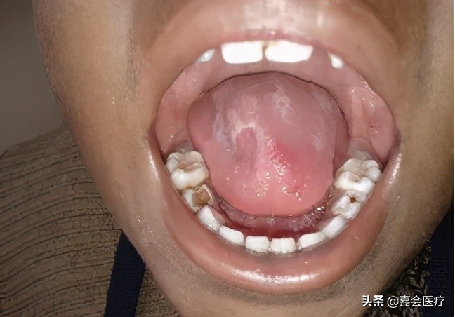 What's the matter with the map tongue?Need intervention treatment? - iNEWS