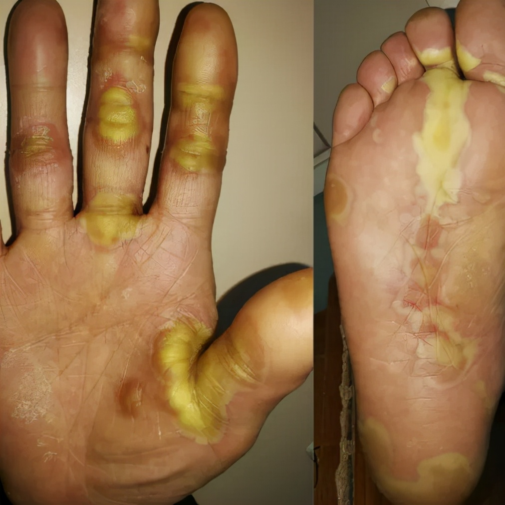 Treatment strategies for skin damage caused by targeted drugs - iNEWS