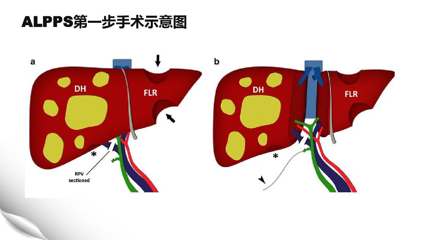 肝癌手術治療的新方法：分階段分肝切除術（ALPPS） - 頭條匯