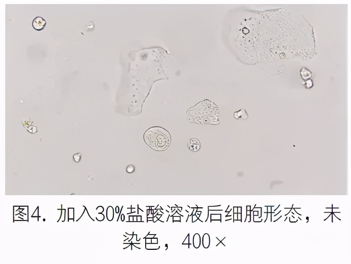 Key points for the identification of special forms of calcium oxalate ...